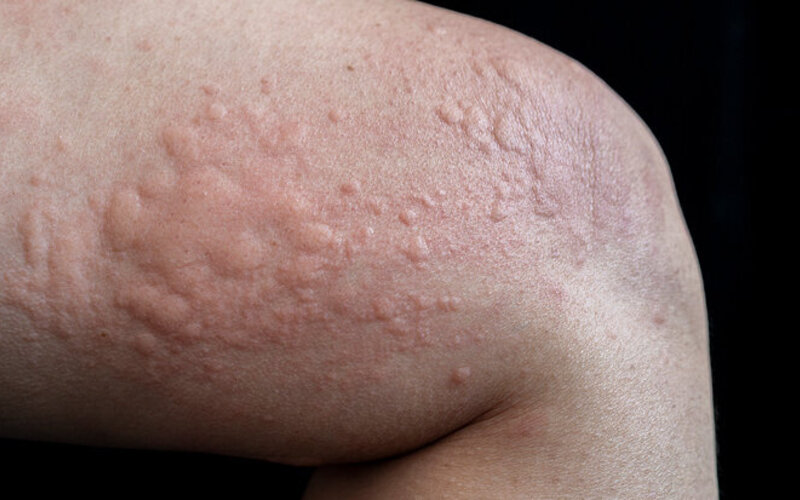 Eichenprozessionsspinner: Gefährliche Schmetterlings-Raupe