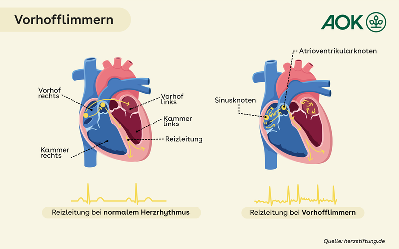 Vorhofflimmern – die wichtigsten Informationen