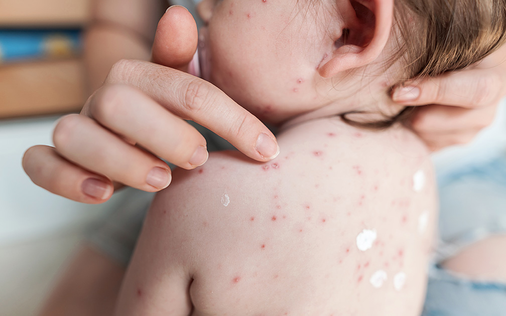 Leichte Windpocken Bei Erwachsenen